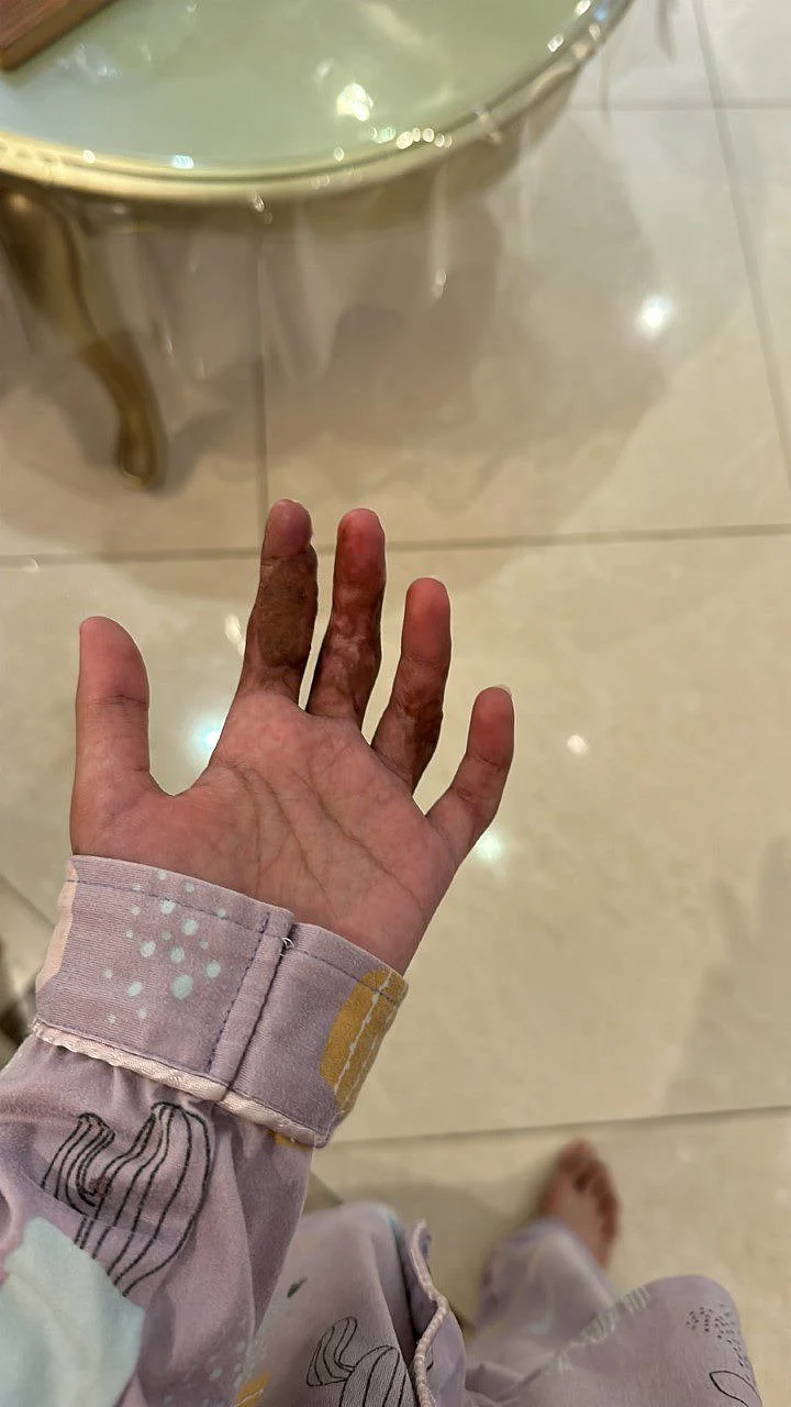 Abu Dhabi: Emirati girl’s fingers saved from amputation after marble ...
