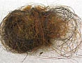 Half kg hairball removed from girl’s stomach | Khaleej Times