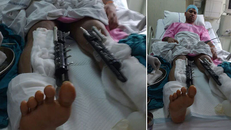 Indian man undergoes surgery to lengthen his legs | Khaleej Times
