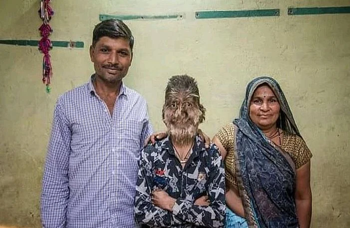 Indian boy has rare ailment that turns him into a 'werewolf'