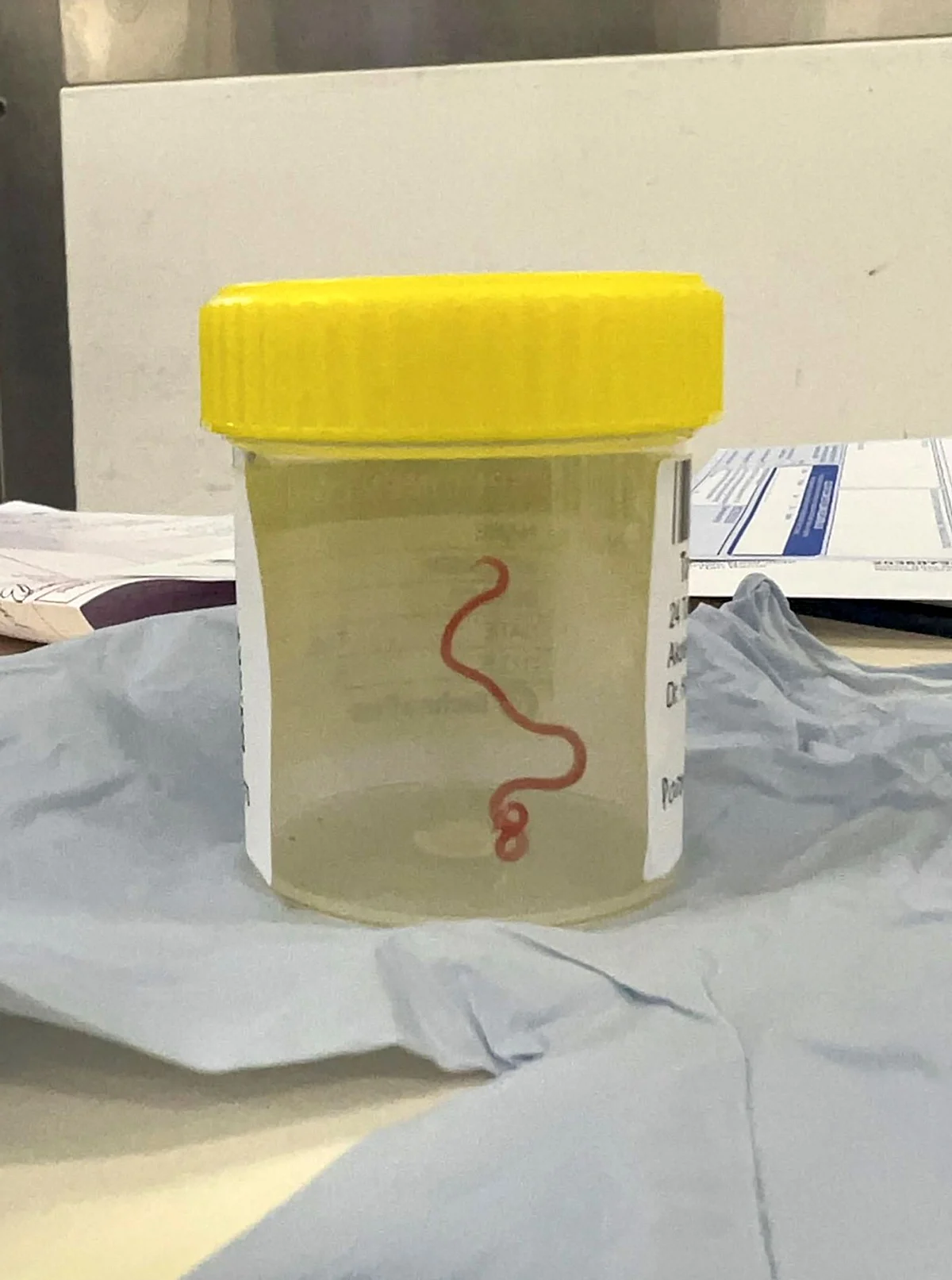 In a first, live worm found inside woman’s brain in Australia | Khaleej ...