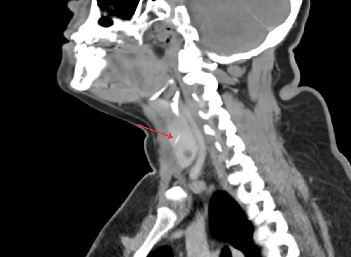 Dubai: Fishbone gets stuck in expat's throat, surgery prevents life ...