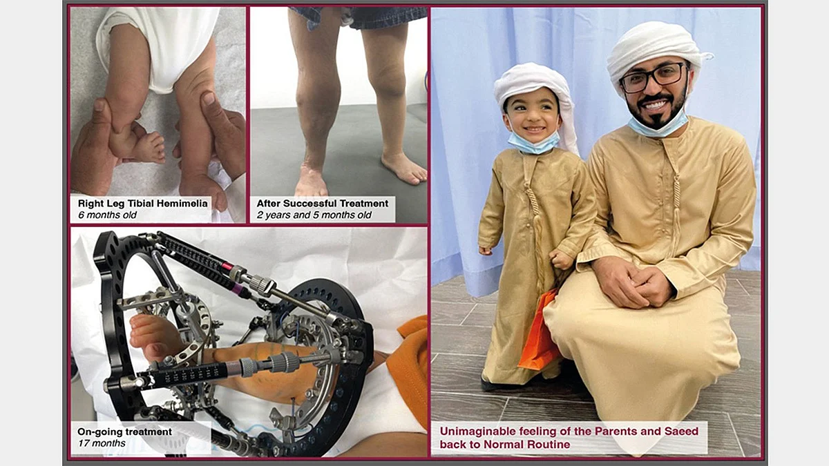 Timely intervention saves child's leg from amputation | Khaleej Times